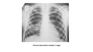 Lecture 2. Primary TB.pptx