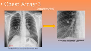 Organization of detection and diagnostics of tuberculosis | PPTX