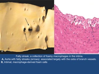 Lecture 2- atherosclerosis.ppt