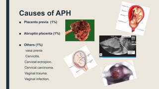 Lecture 20 Antepartum Hemorrhage .pptx