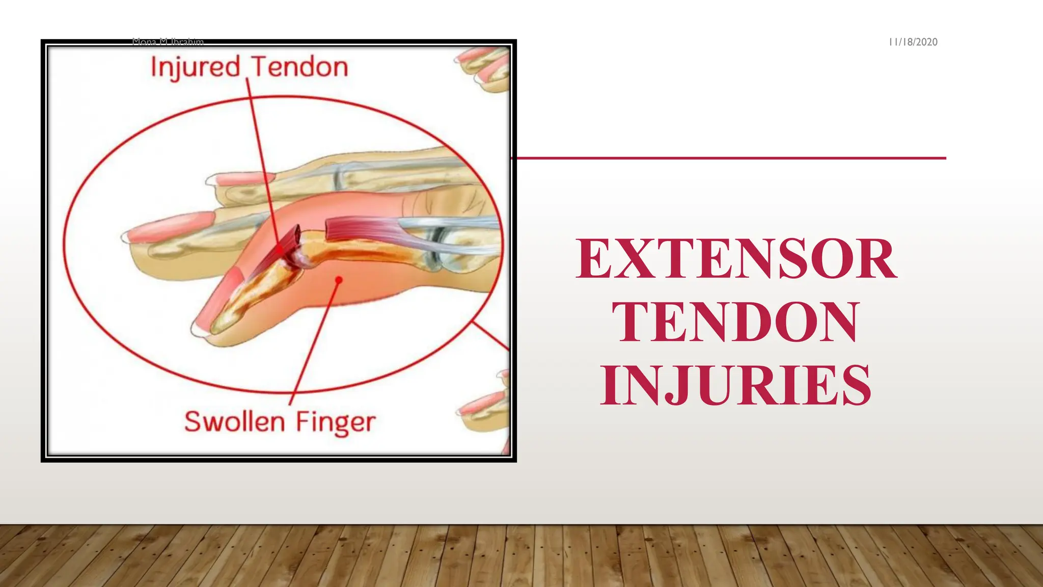 lecture 21(Extensor Tendon Injuries) .pdf