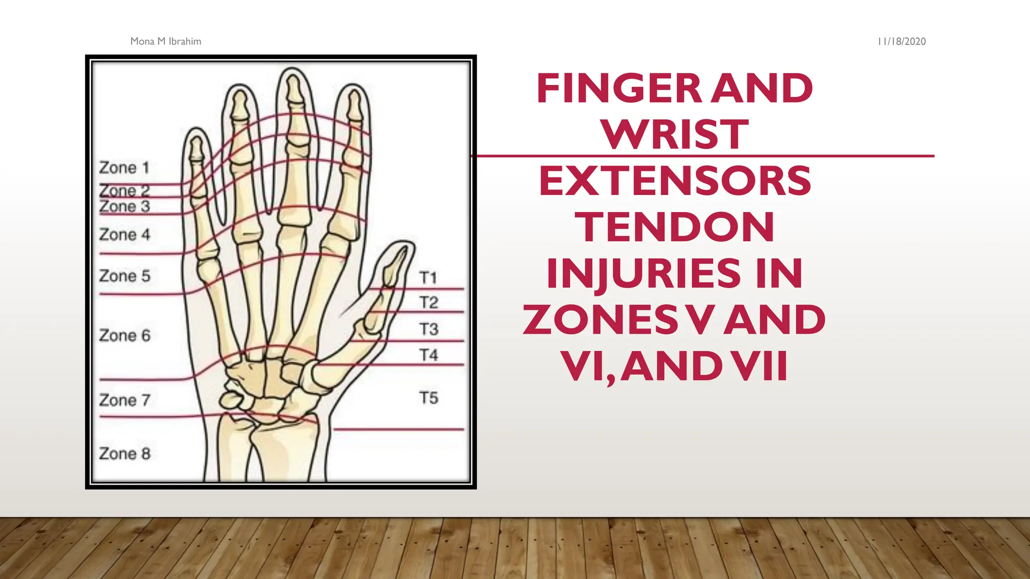 lecture 21(Extensor Tendon Injuries) .pdf
