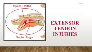 lecture 21(Extensor Tendon Injuries) .pdf