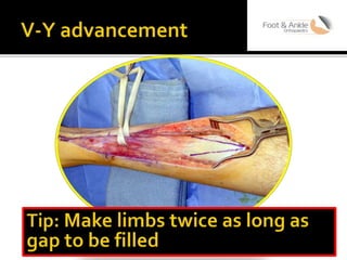 Lecture 21 shah chronic achilles rupture | PPTX