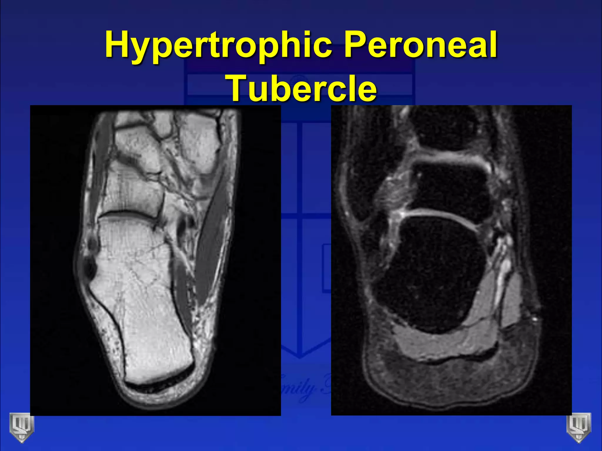 Lecture 23 24 parekh peroneal pathology | PPTX