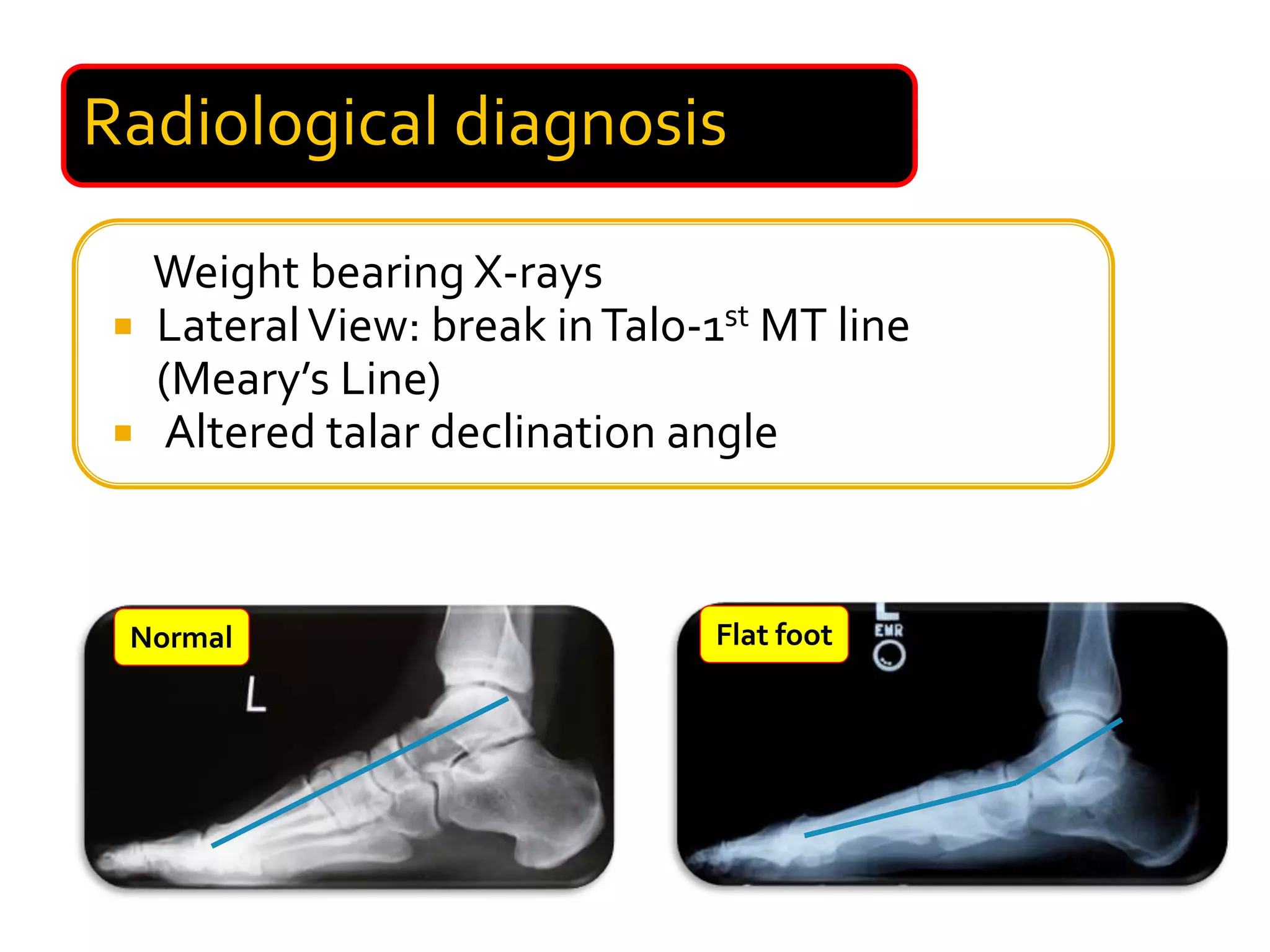 Lecture 25 shah flat foot conservative | PPTX