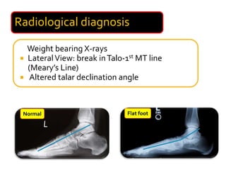 Lecture 25 shah flat foot conservative | PPTX