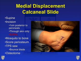 Medial Calcaneal Osteotomy