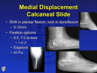 Medial Calcaneal Osteotomy