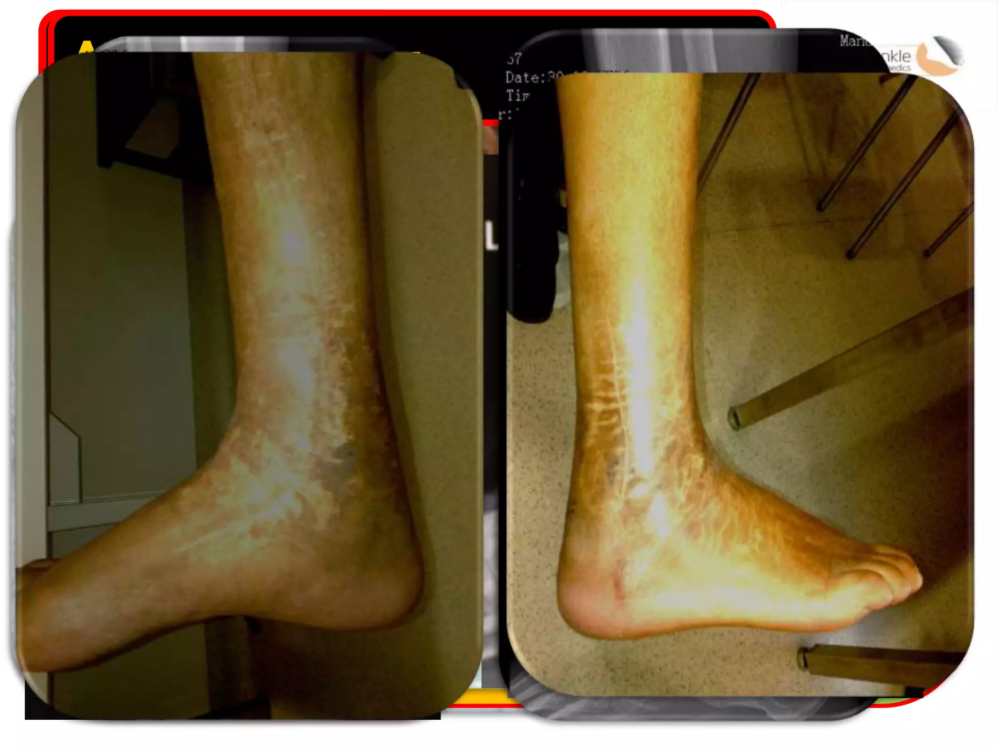 Lecture 29 shah diabetic fractures copy | PPTX