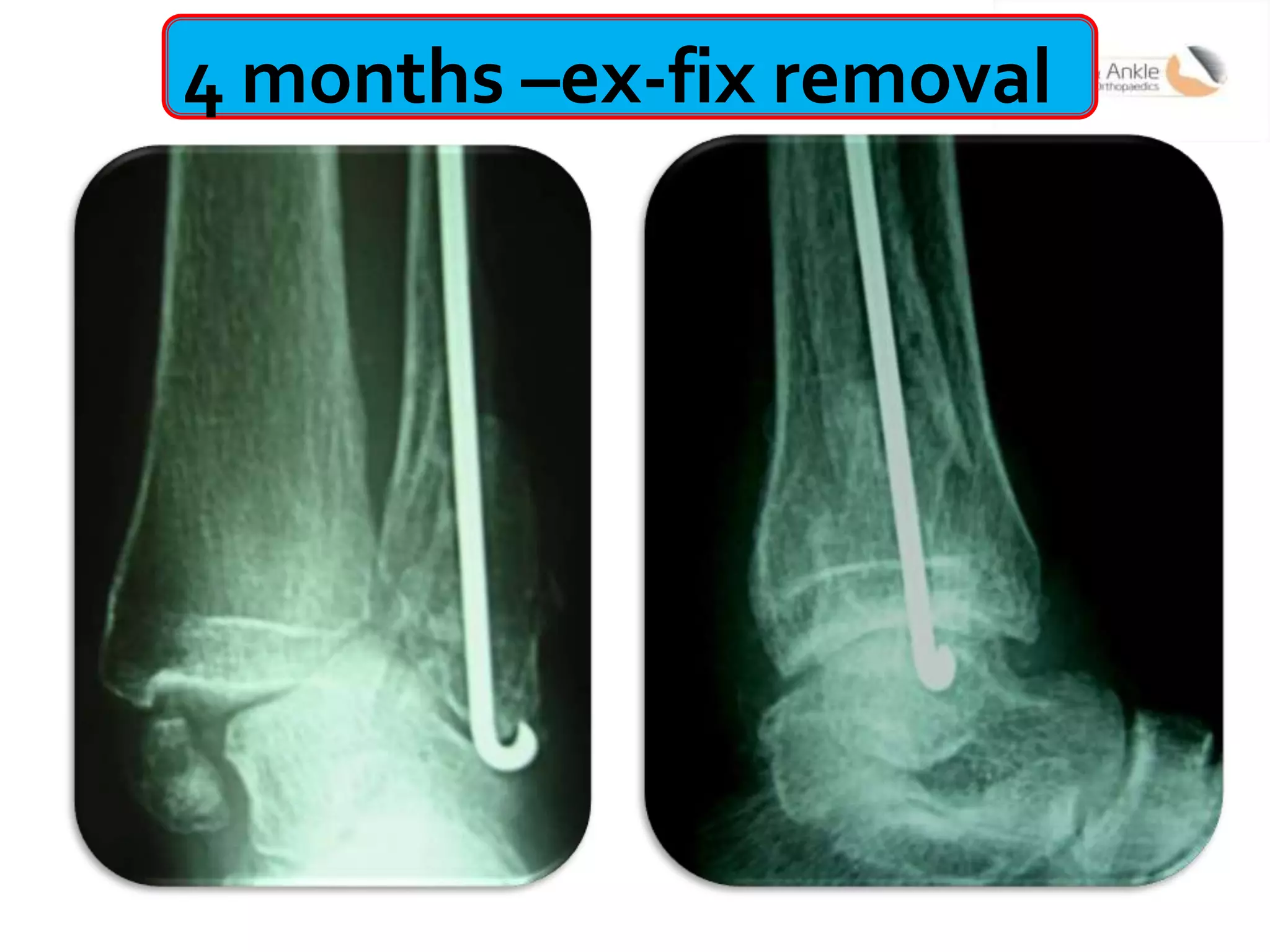Lecture 29 shah diabetic fractures copy | PPTX