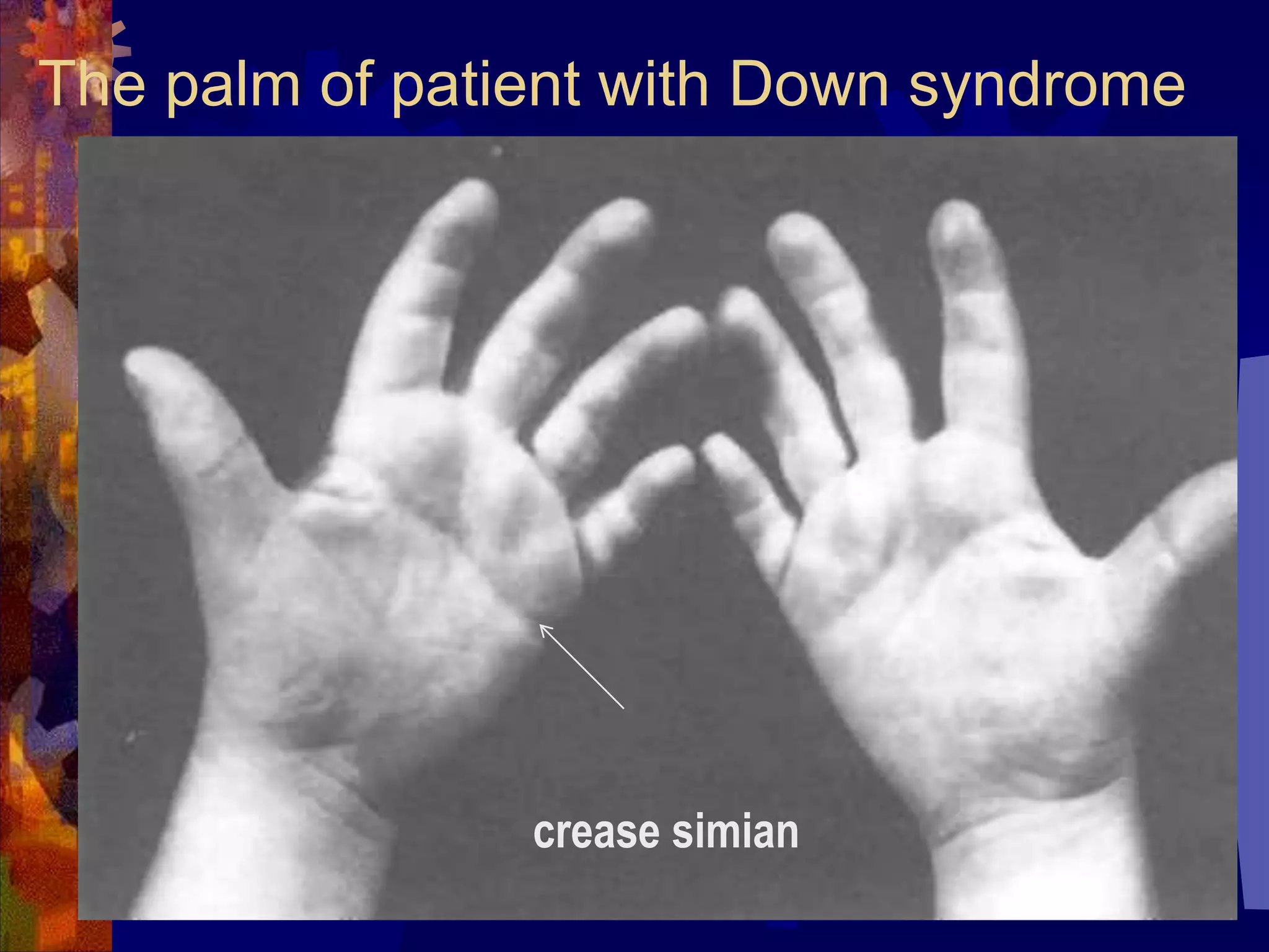 Lecture 2 Chromosomal diseases (1).ppt