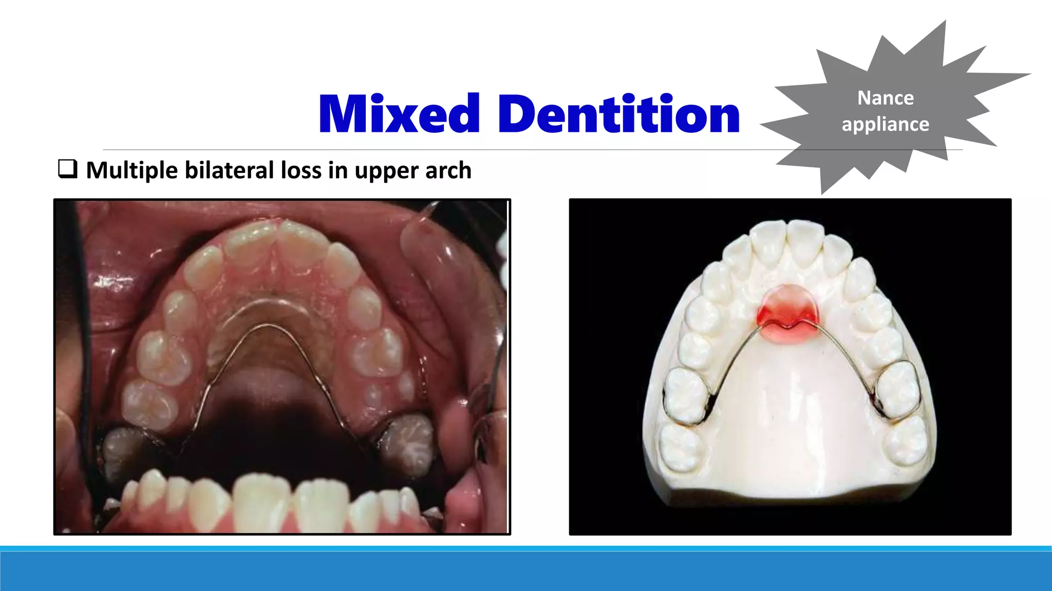 Lecture 2 managment of the developing dentition | PPTX