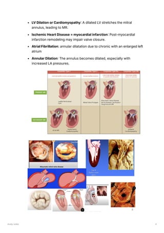 lecture 2 of cardiac diseases mitral regurgitations.pdf | Lung and ...