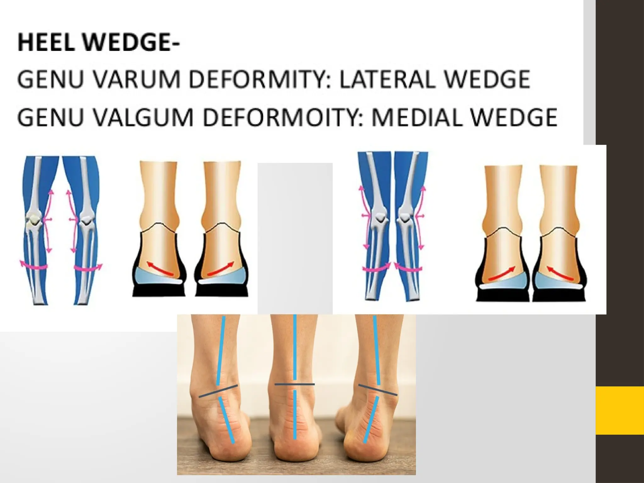 Lecture#2 Orthopedic Footwear and Shoe Modifications.pptx