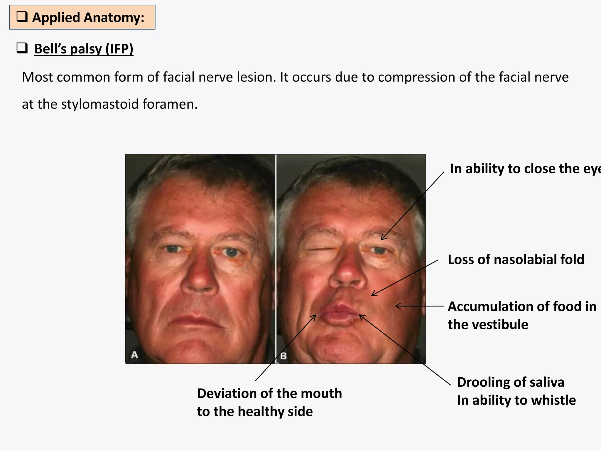 Lecture 2 (The parotid gland and the extracranial part of the facial ...