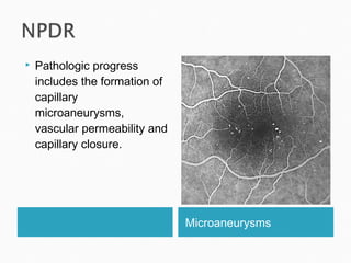 Lecture 3: Diabetic Retinopathy | PPT