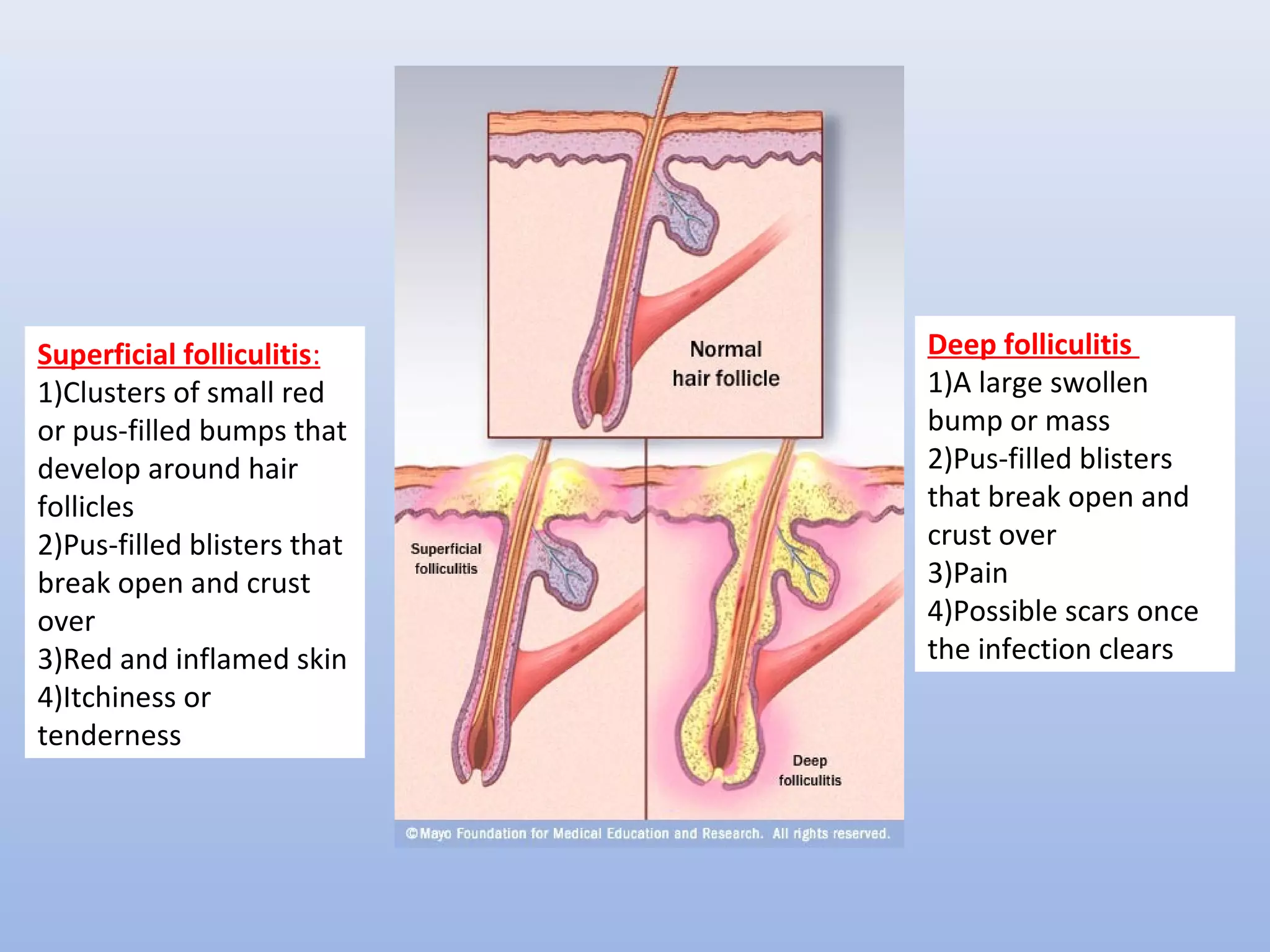 Lecture 3. diseases caused by bacterial infection | PPT