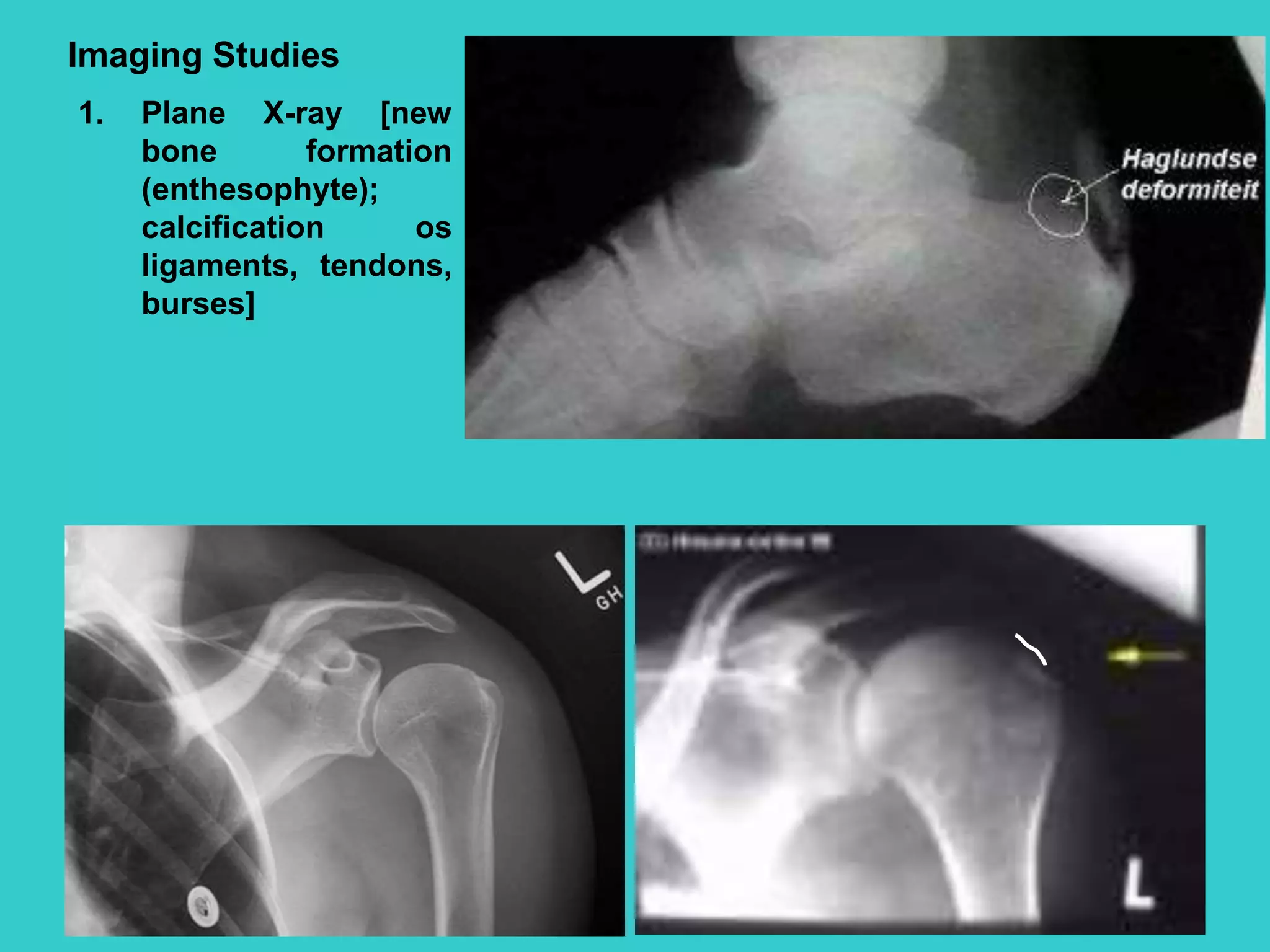 Inflammatory Periarticular Lesions Lecture 3 | PPT