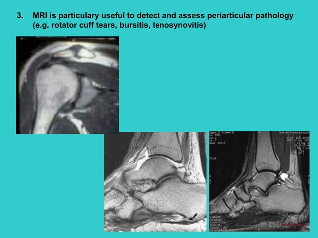 Inflammatory Periarticular Lesions Lecture 3 | PPT