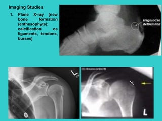 Inflammatory Periarticular Lesions Lecture 3 | PPT