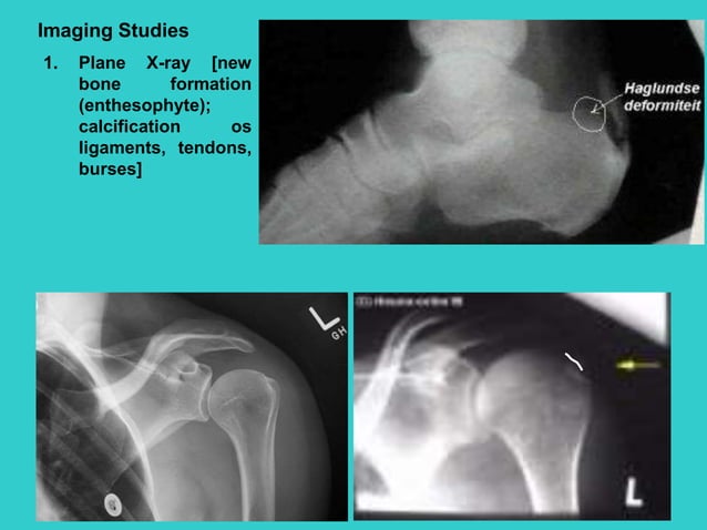 Inflammatory Periarticular Lesions Lecture 3 | PPT