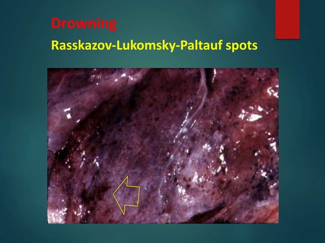 Lecture 3. Forensic examination of mechanical asphyxia.ppt