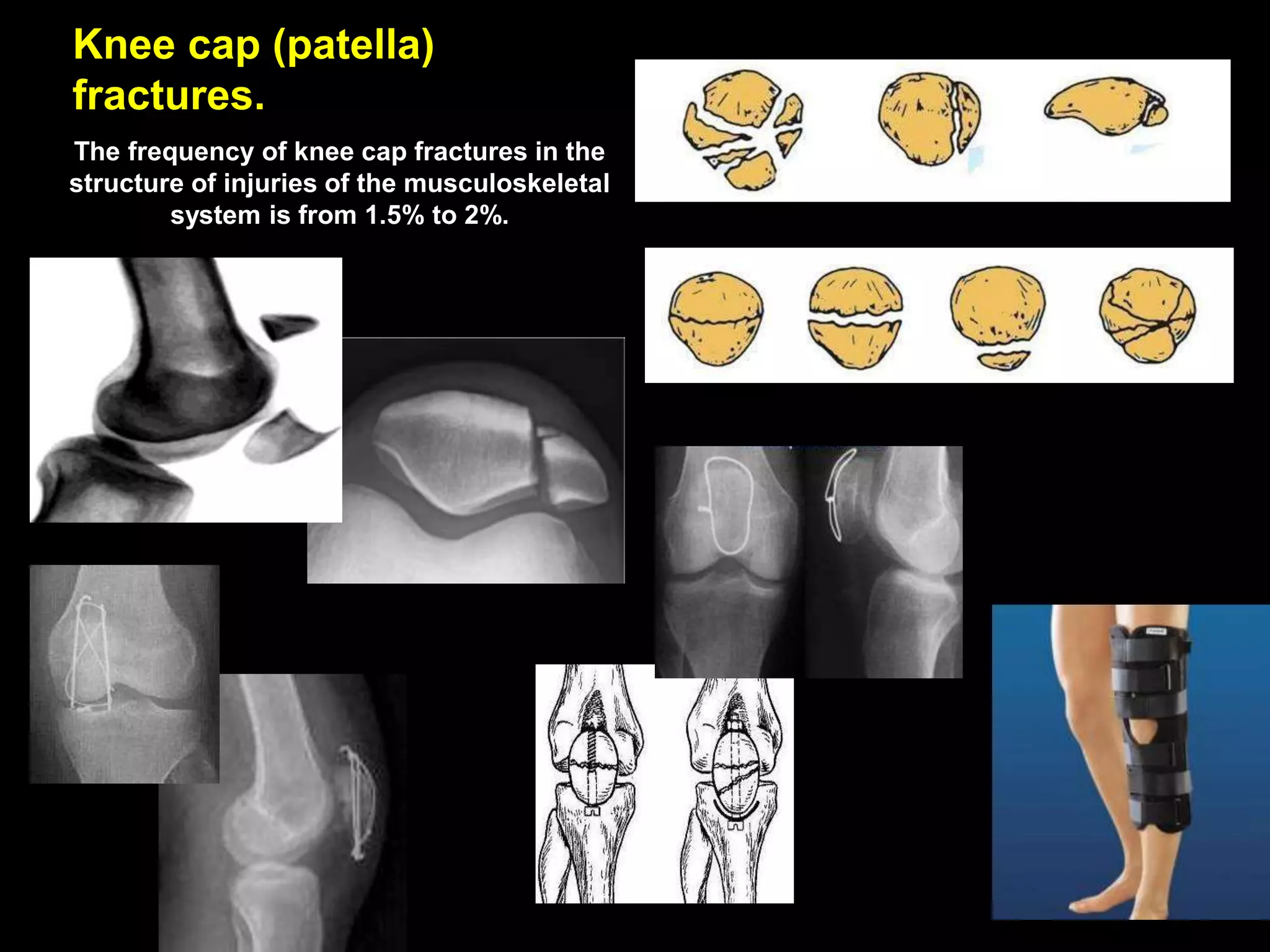 Lecture 3 - Lower extremity injuries | PPTX