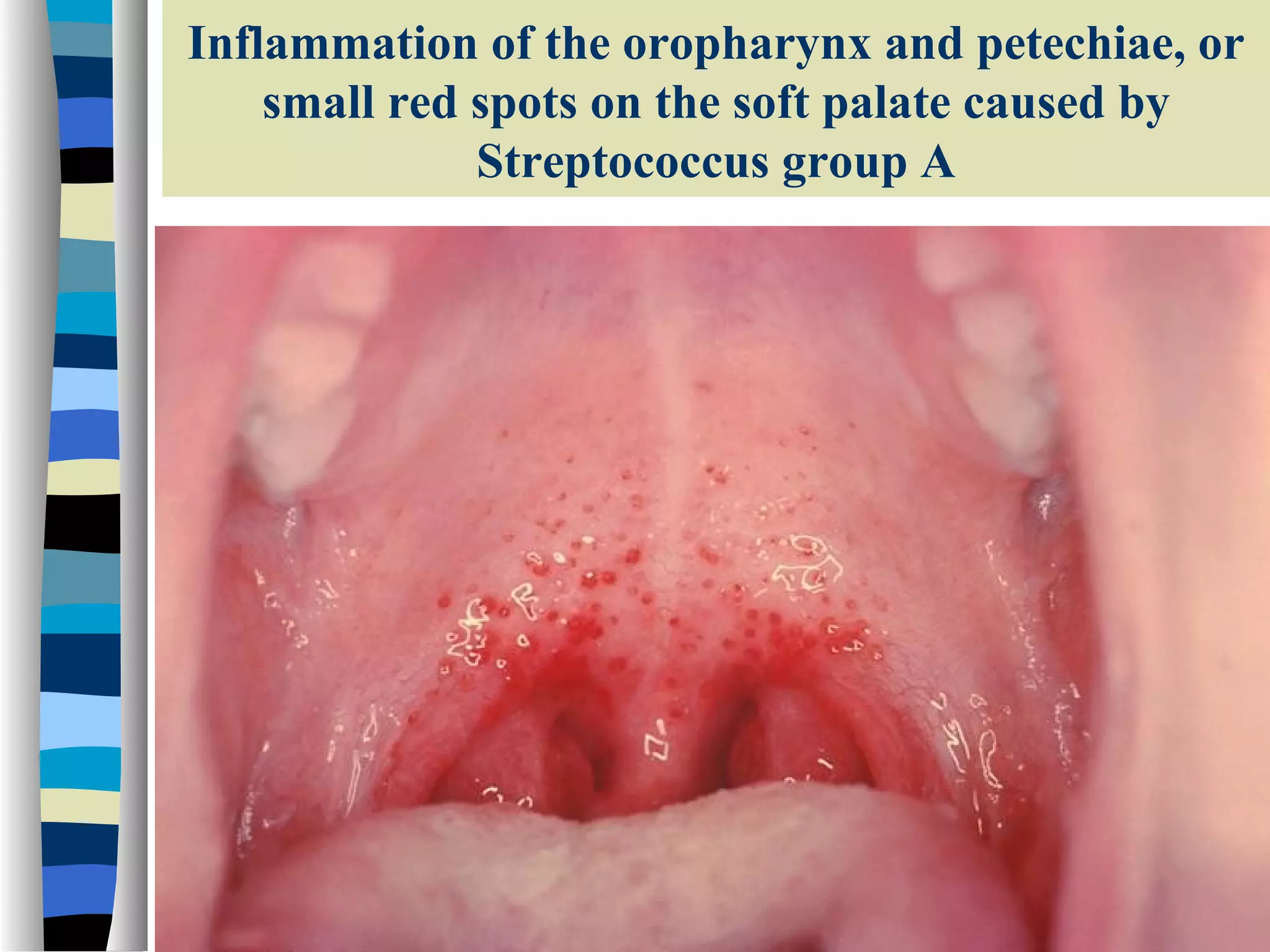 Lecture 3 Streptococcus pyogenes | PPT