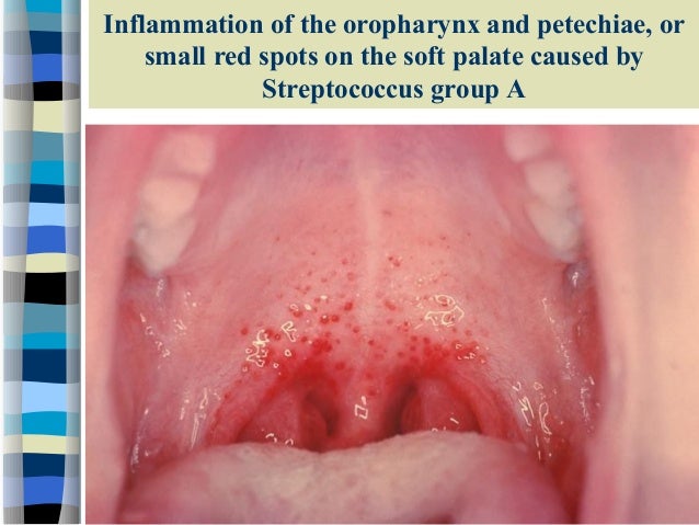 Lecture 3 Streptococcus Pyogenes Lecture 3 Streptococcus Pyogenes