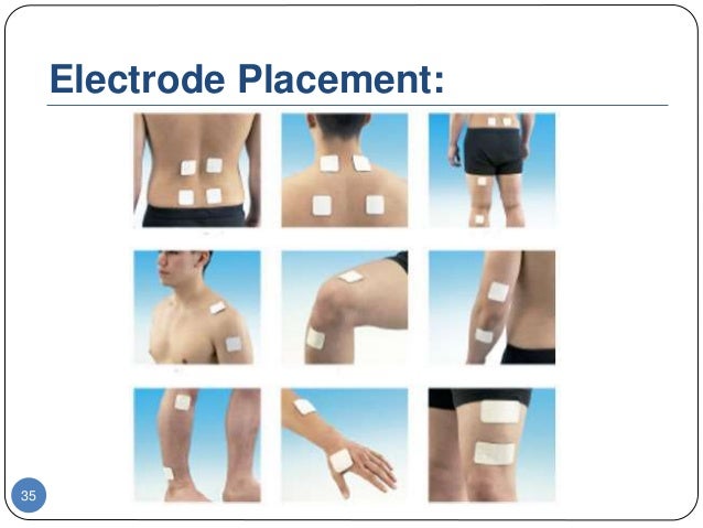 Transcutaneous electrical nerve stimulation (TENS)