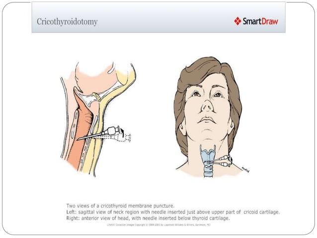 Lecture 30. CRICOTHYROIDOTOMY.pptxzbendj | PPTX | Thyroid Disorders ...