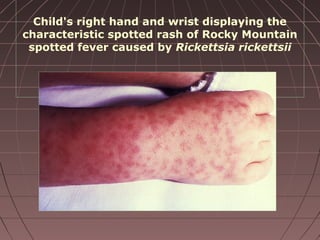 Lecture 30 Rickettsia and Coxiella | PPT