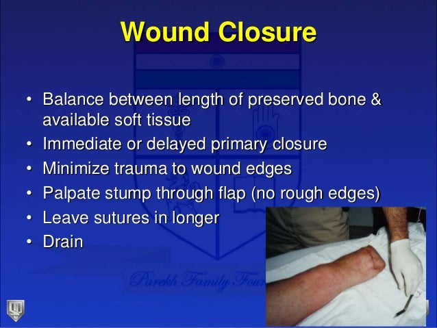 Lecture 31 parekh amputations