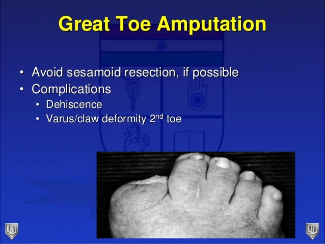 Lecture 31 parekh amputations