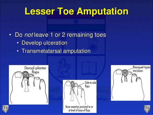 Lecture 31 parekh amputations