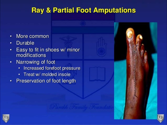 Lecture 31 parekh amputations