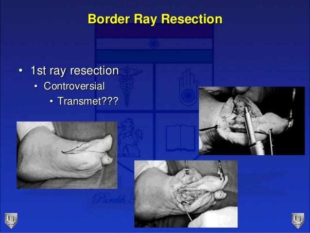 Lecture 31 parekh amputations