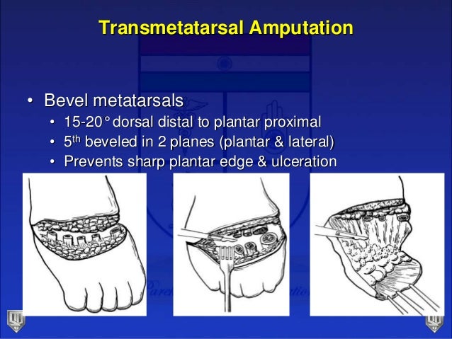 Trans Phalangeal Amputation | Open Mouth, Insert Foot: Partial Foot and ...