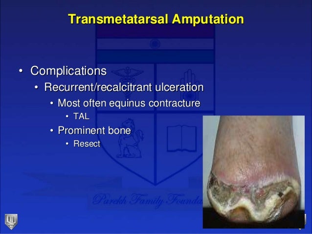 Lecture 31 parekh amputations