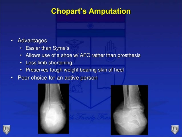 Lecture 31 parekh amputations