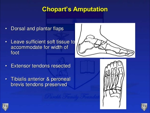 Lecture 31 parekh amputations