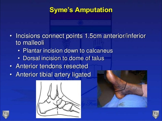 Lecture 31 parekh amputations
