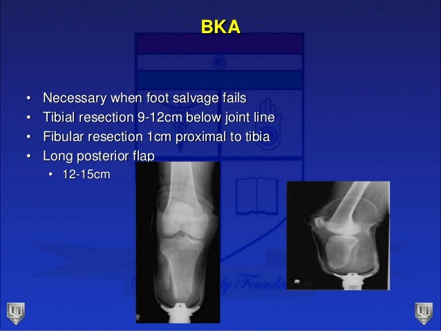 Lecture 31 parekh amputations