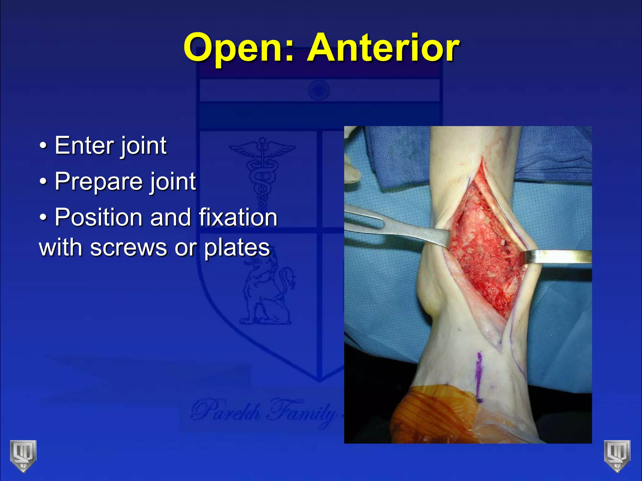 Lecture 33 34 Parekh Ankle Arthritis Ppt