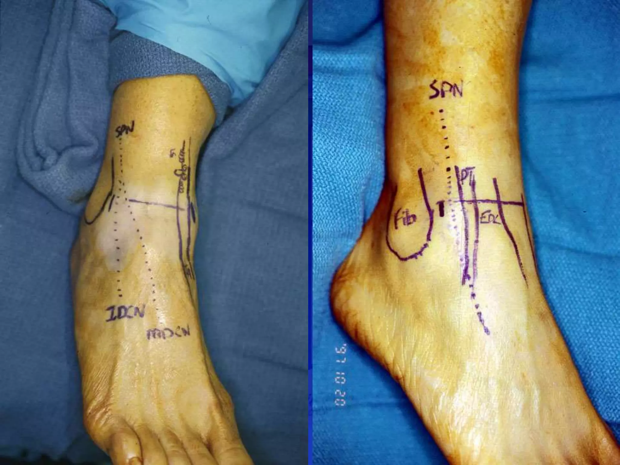 Lecture 33 34 Parekh Ankle Arthritis Ppt