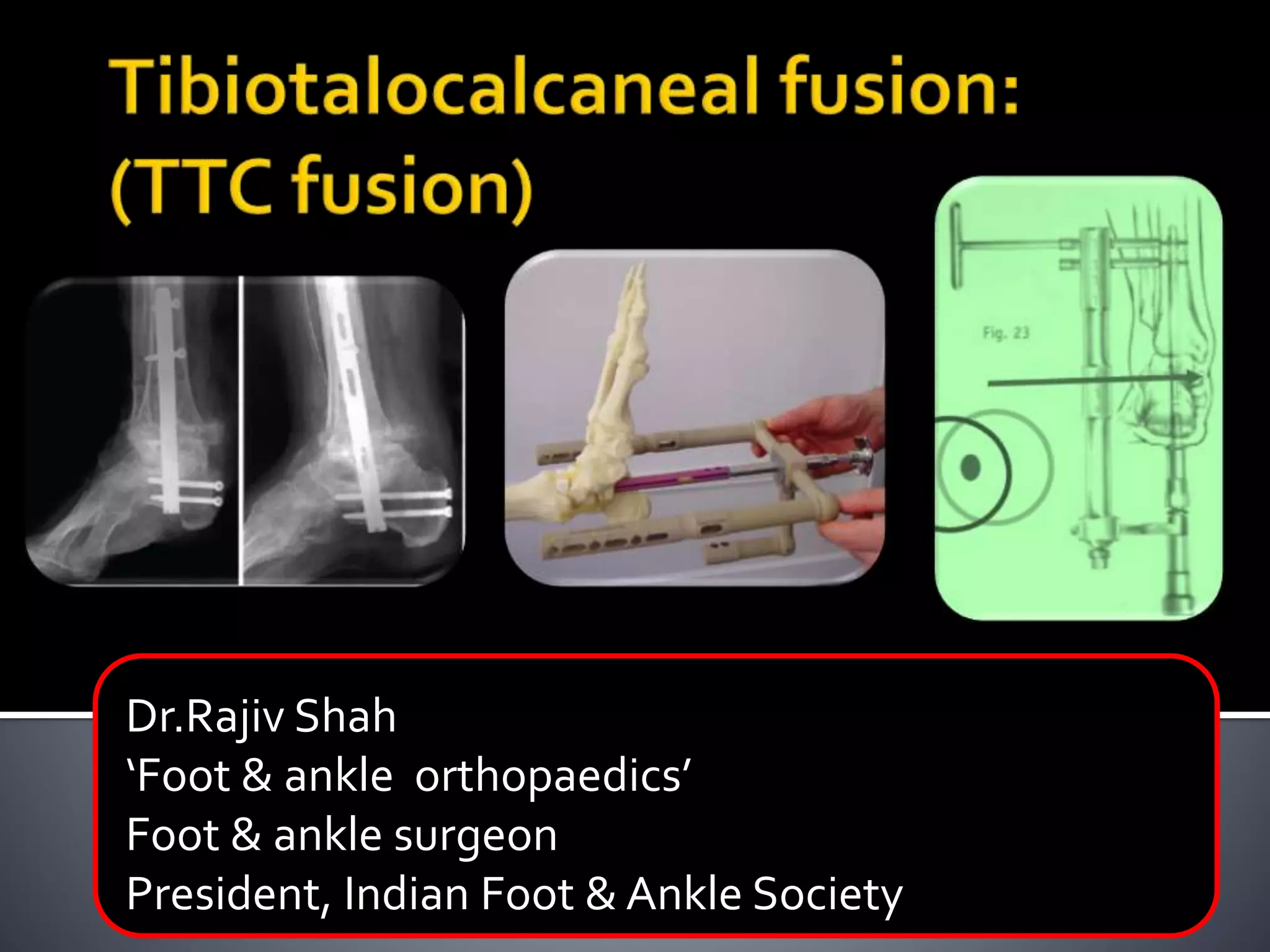 Lecture 37 shah ttc fusion | PPTX
