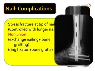 Lecture 37 shah ttc fusion | PPTX
