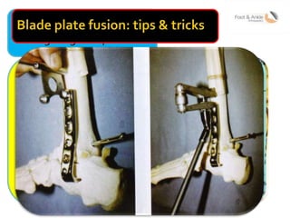 Lecture 37 shah ttc fusion | PPTX