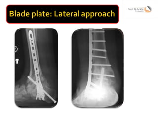 Lecture 37 shah ttc fusion | PPTX